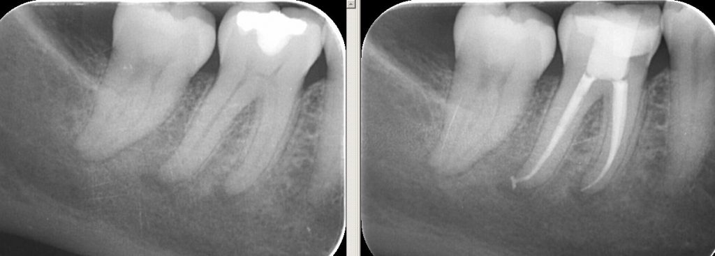 46 rct (2) - Beech House Dental Practice